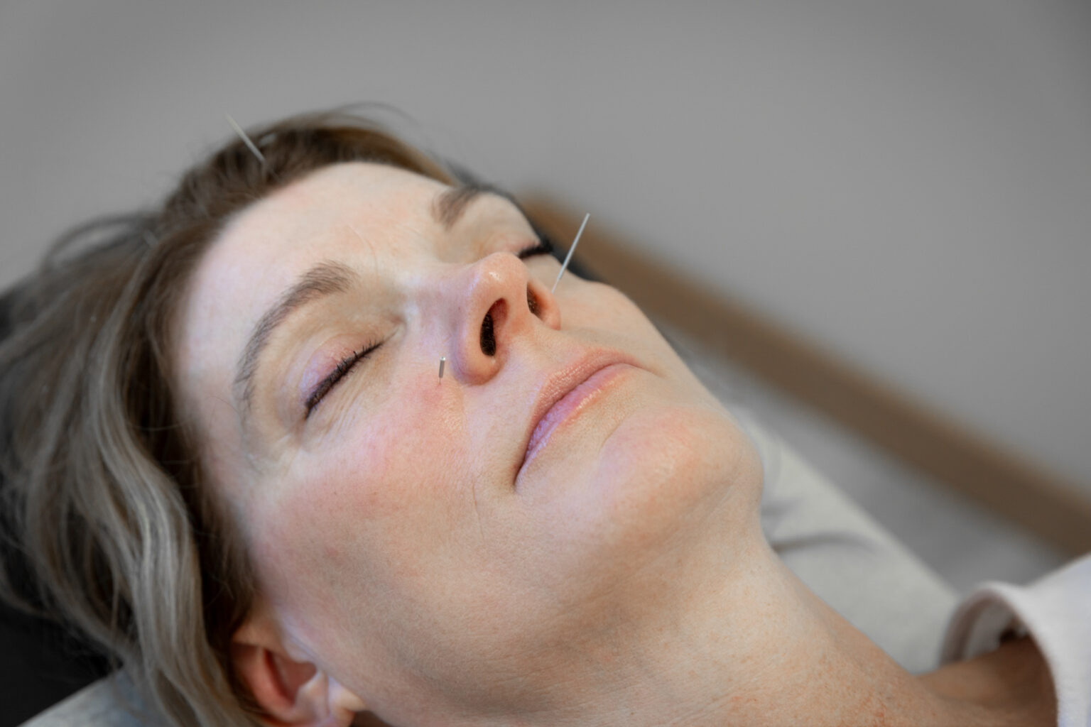 Acupuncture in Fargo and Fergus Falls | REVIV Medical